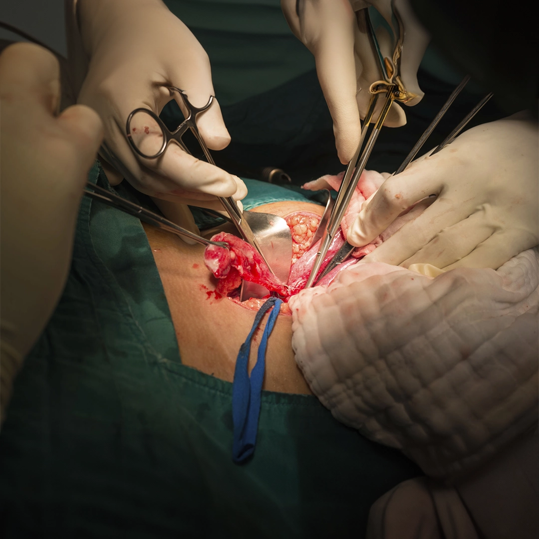 Paediatric Laparoscopy & Thoracoscopy – Dr. Raghul